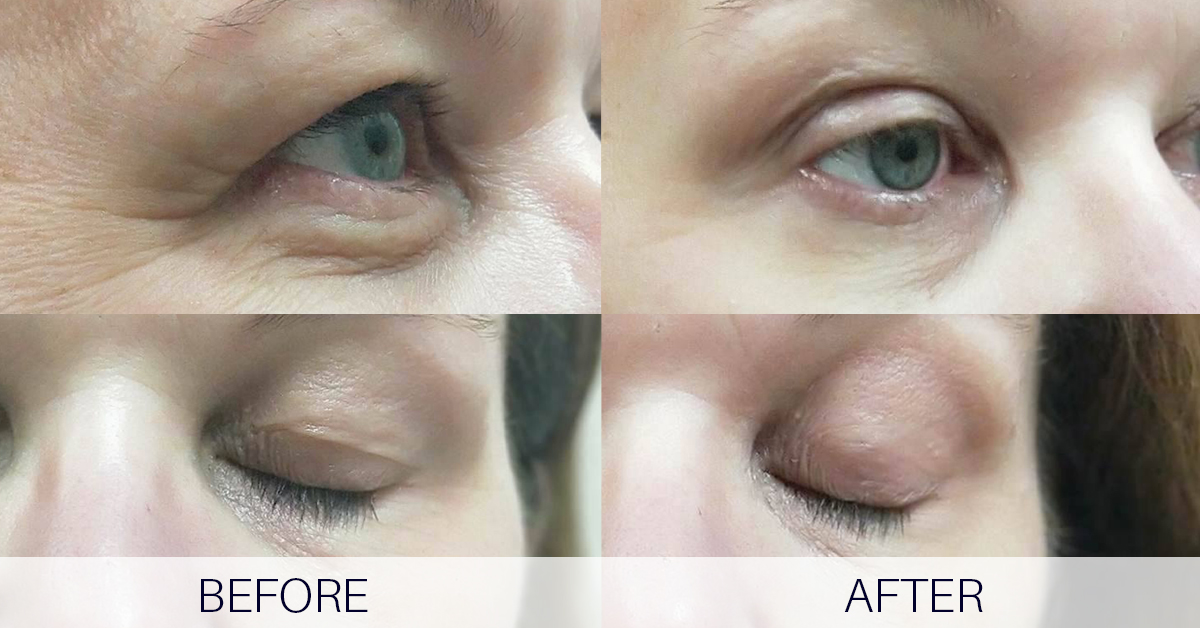 Plasma Fibroblast Skin Tightening - Envy Beauty Aesthetics