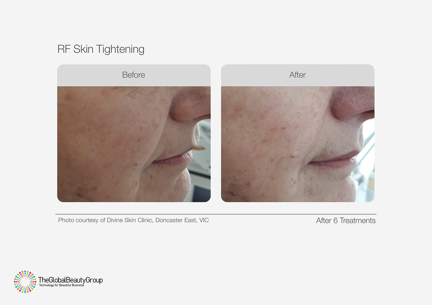 RF Skin Tightening - Envy Beauty Aesthetics
